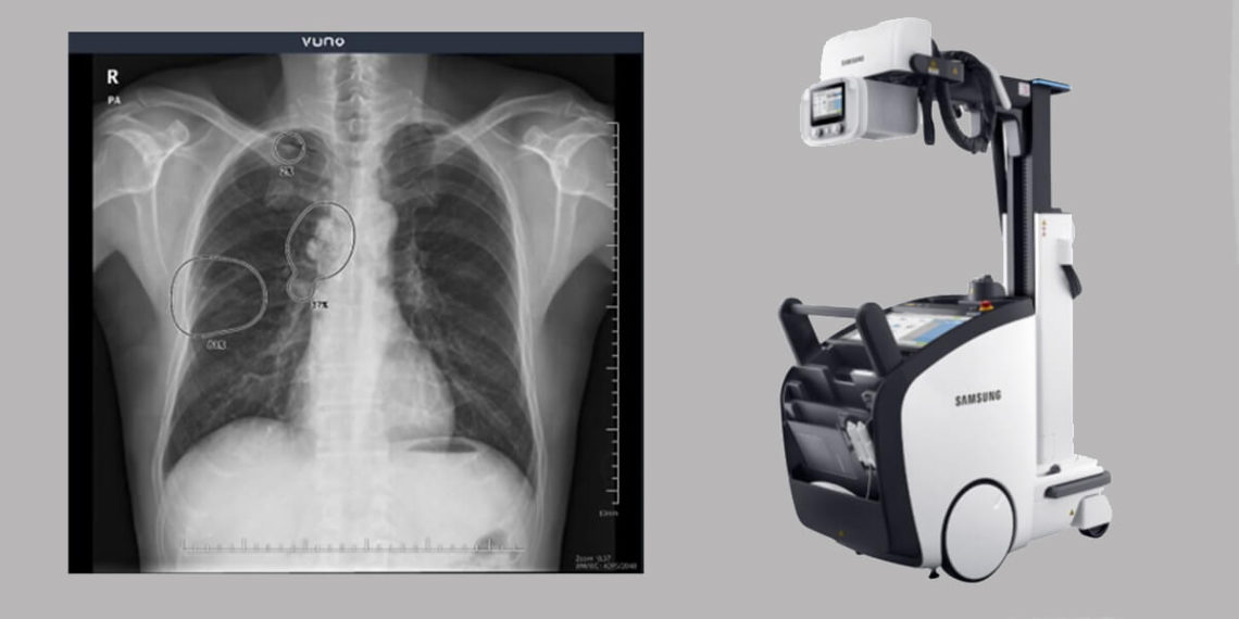 AI Medical Tech Startup VUNO Enhances Samsung’s X-ray System